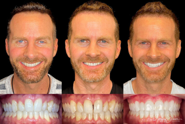 Invisalign Before and After | Dental Treatment Before and After Photos